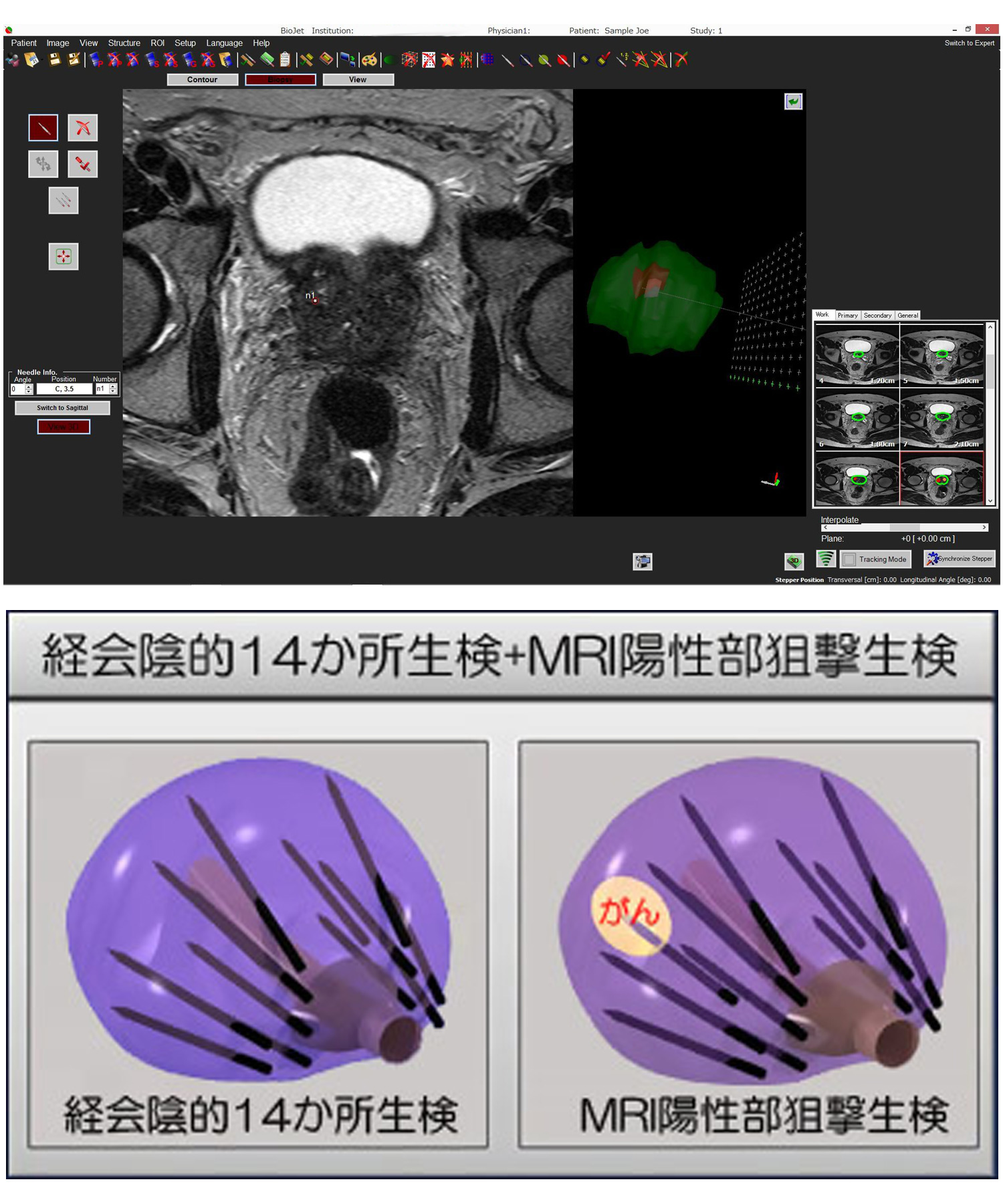 令和7年7月から「3D-融合ガイド下経会陰式前立腺生検システム（BioJet®）を導入します | 大和市立病院